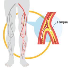 Understanding Peripheral Vascular Disease: Causes, Symptoms, and ...
